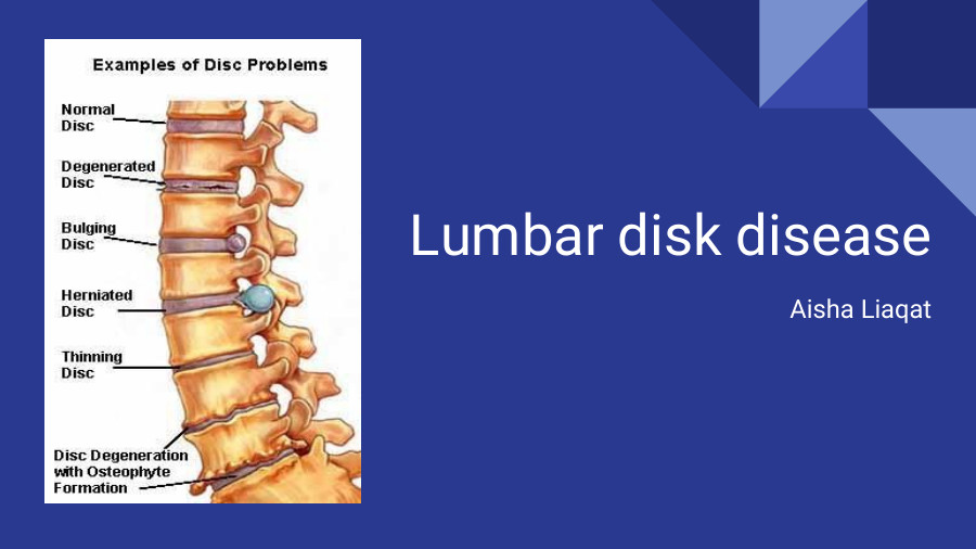 Lumbar disc disease - PowerPoint Slides - MyPrivateTutor Qatar